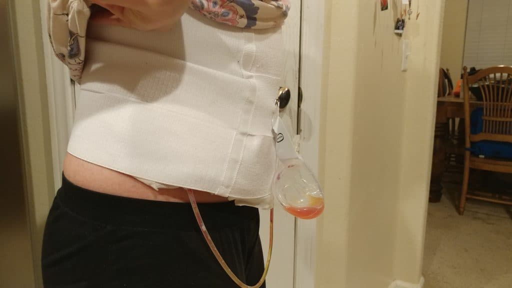 Diastasis Recti Surgery: Pt2 – The Crazy Outdoor Mama